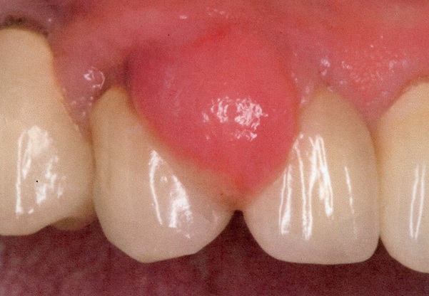 Peripheral Giant Cell Granuloma Vs Pyogenic Granuloma